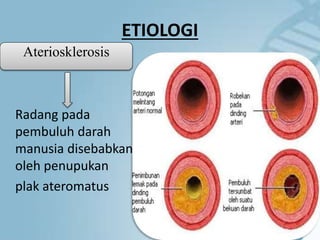 Angina pektoris | PPTX