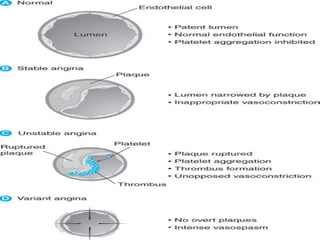 Angina pathophysiology | PPT