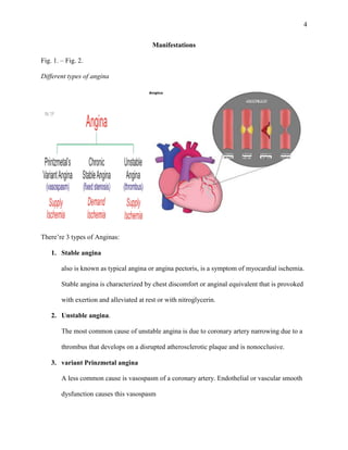 Angina + SOAP note. | DOCX