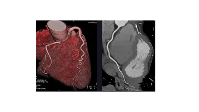 Angio ct of heart and blood vessels | PPTX
