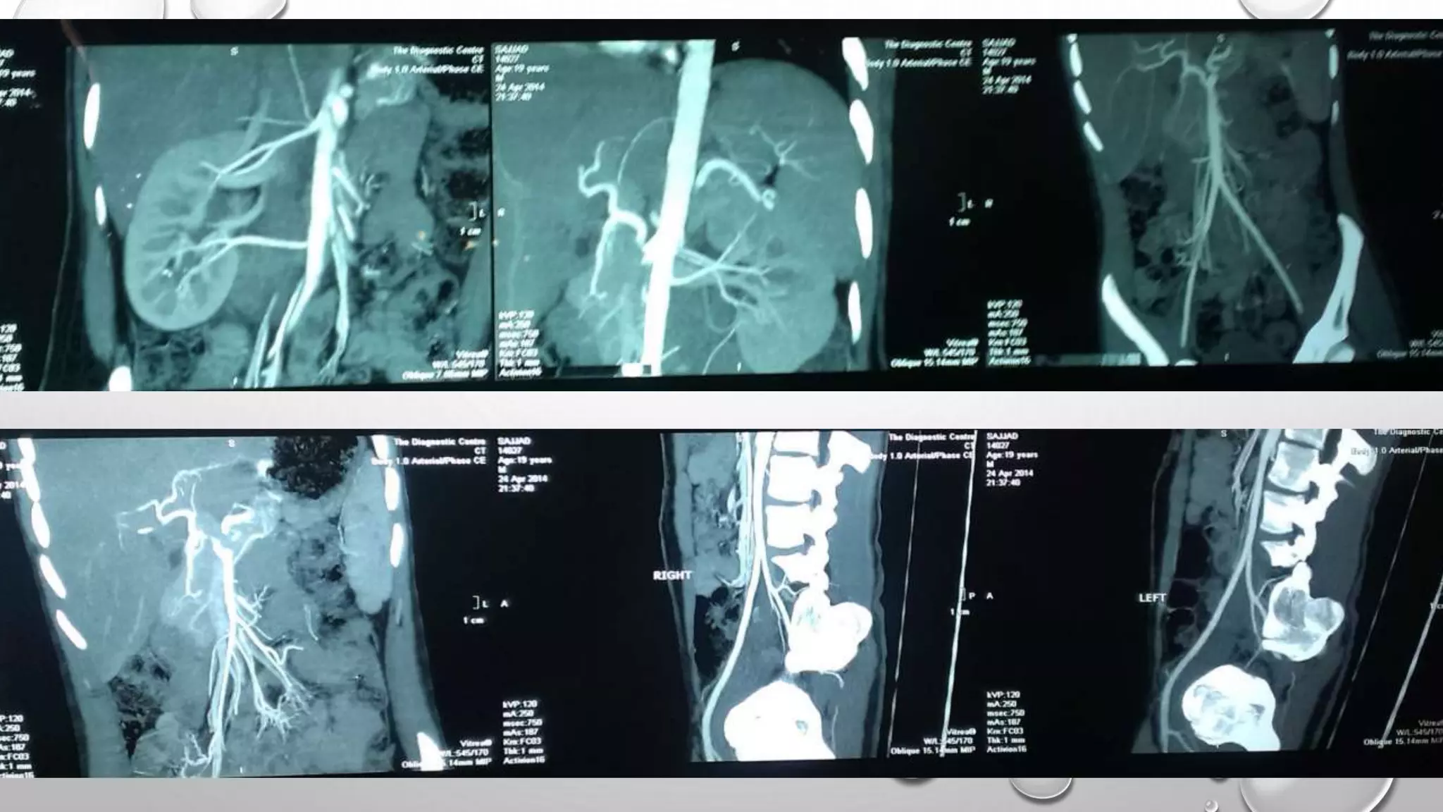 Angiodysplasia of Jejunum | PPTX