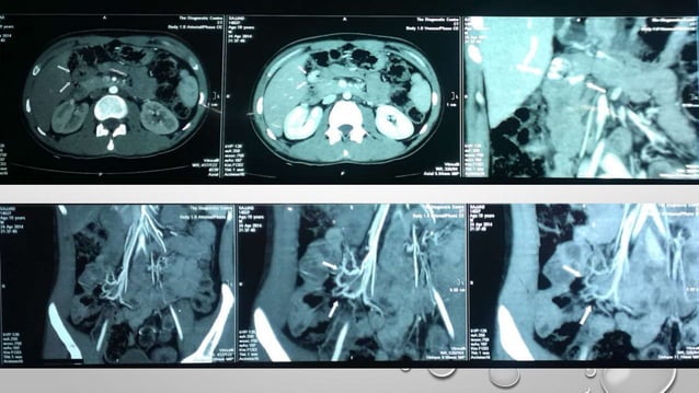 Angiodysplasia of Jejunum | PPTX