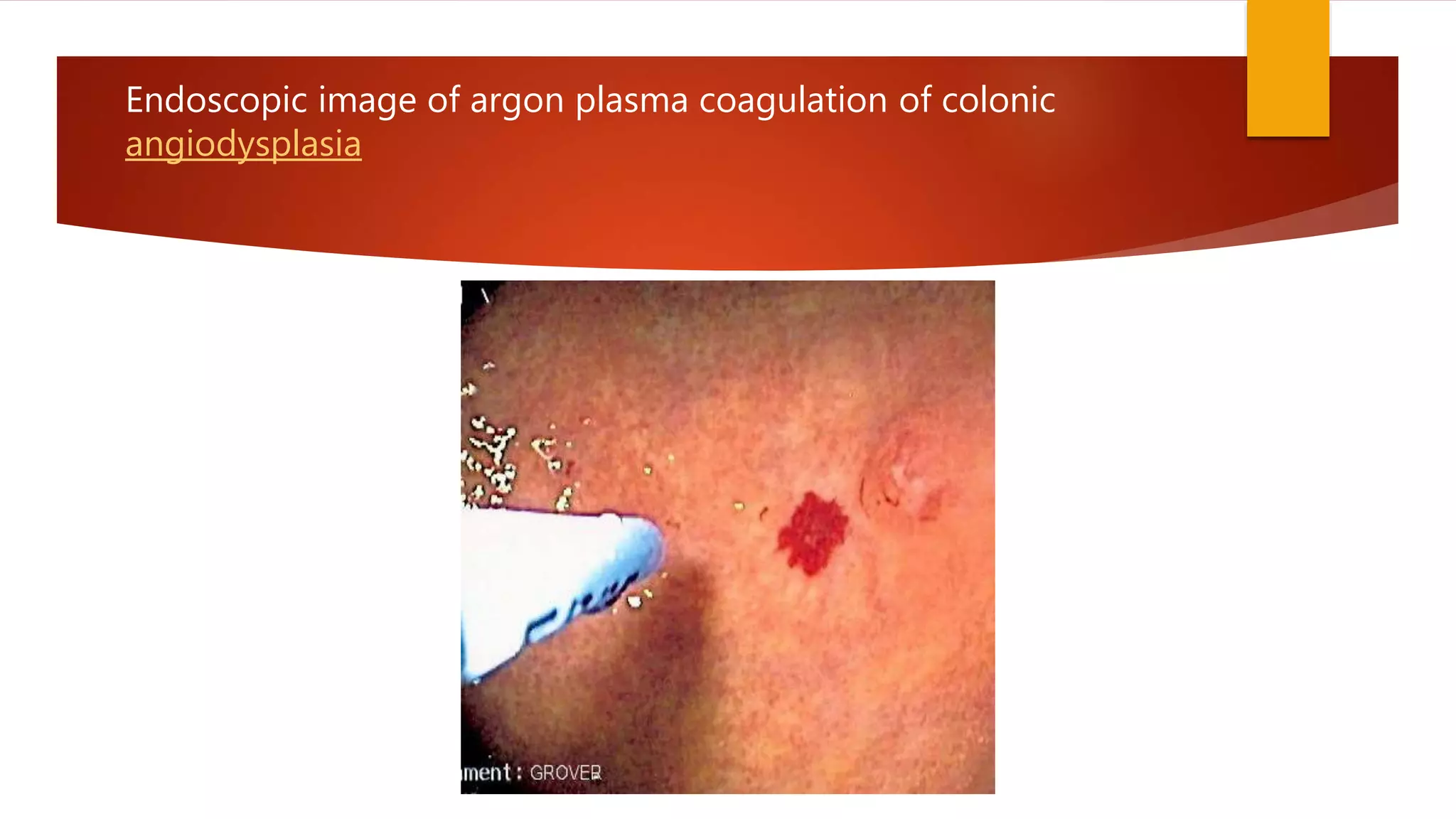 Angiodysplasia[1] | PPTX