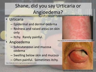 Angioedema | PPTX