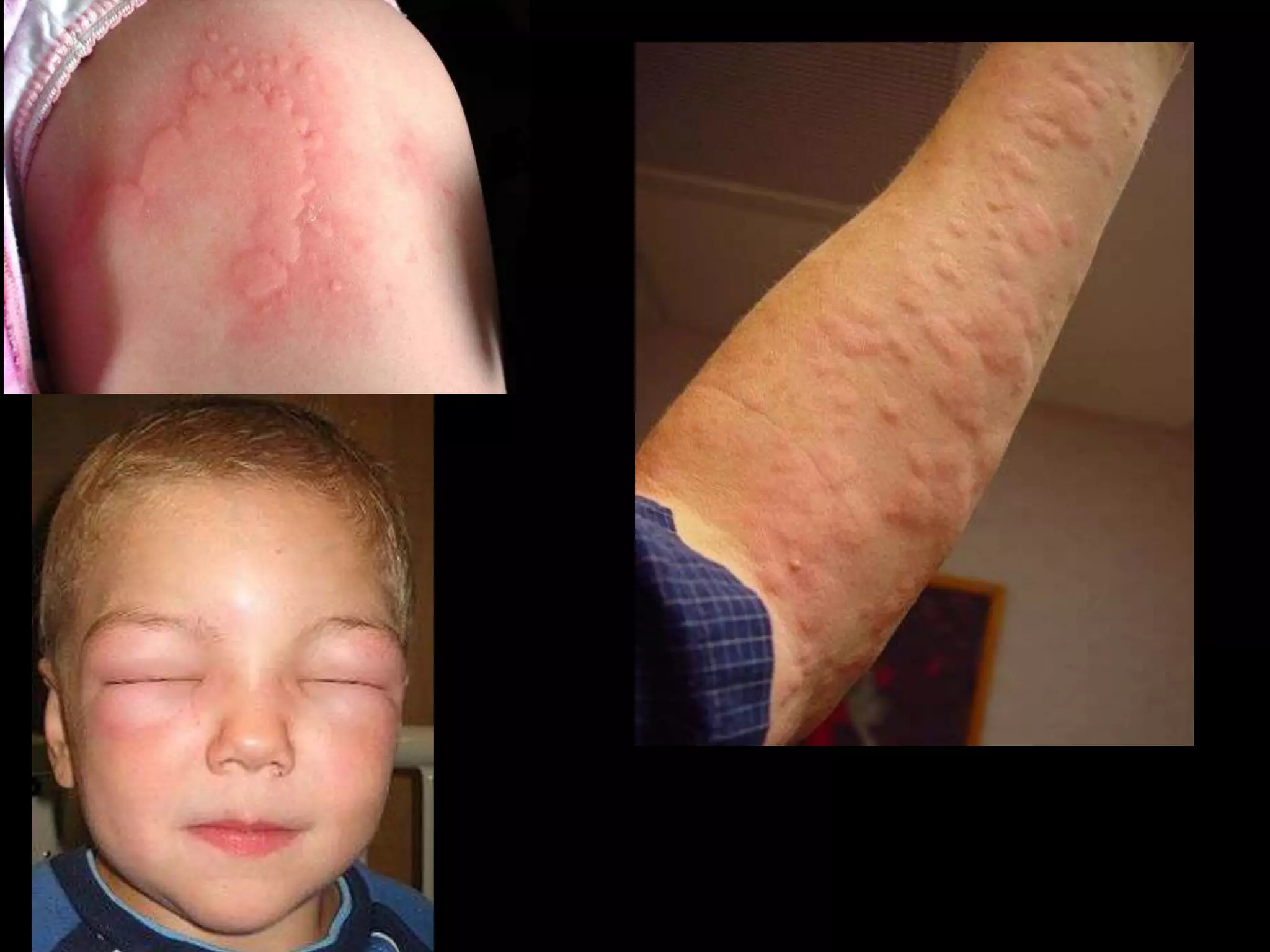 Angioedema Quick Slides | PPTX