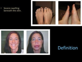 Angioedema Quick Slides | PPTX