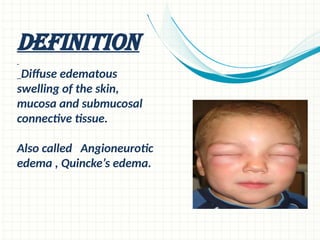 ANGIOEDEMA and DRUG ALLERGY Fluid accumulation in skin and submucosa | PPT
