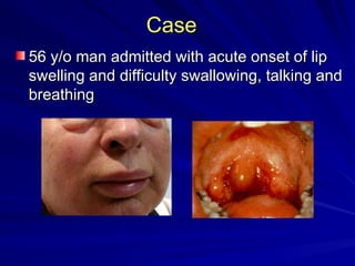 Angioedema PowerPoint Presentation for Medical Residents | PPT