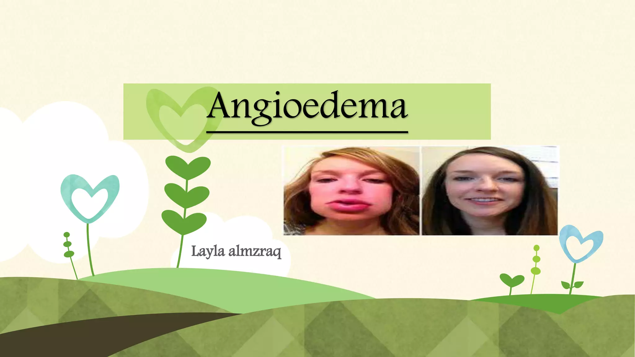 Angioedema | PPTX