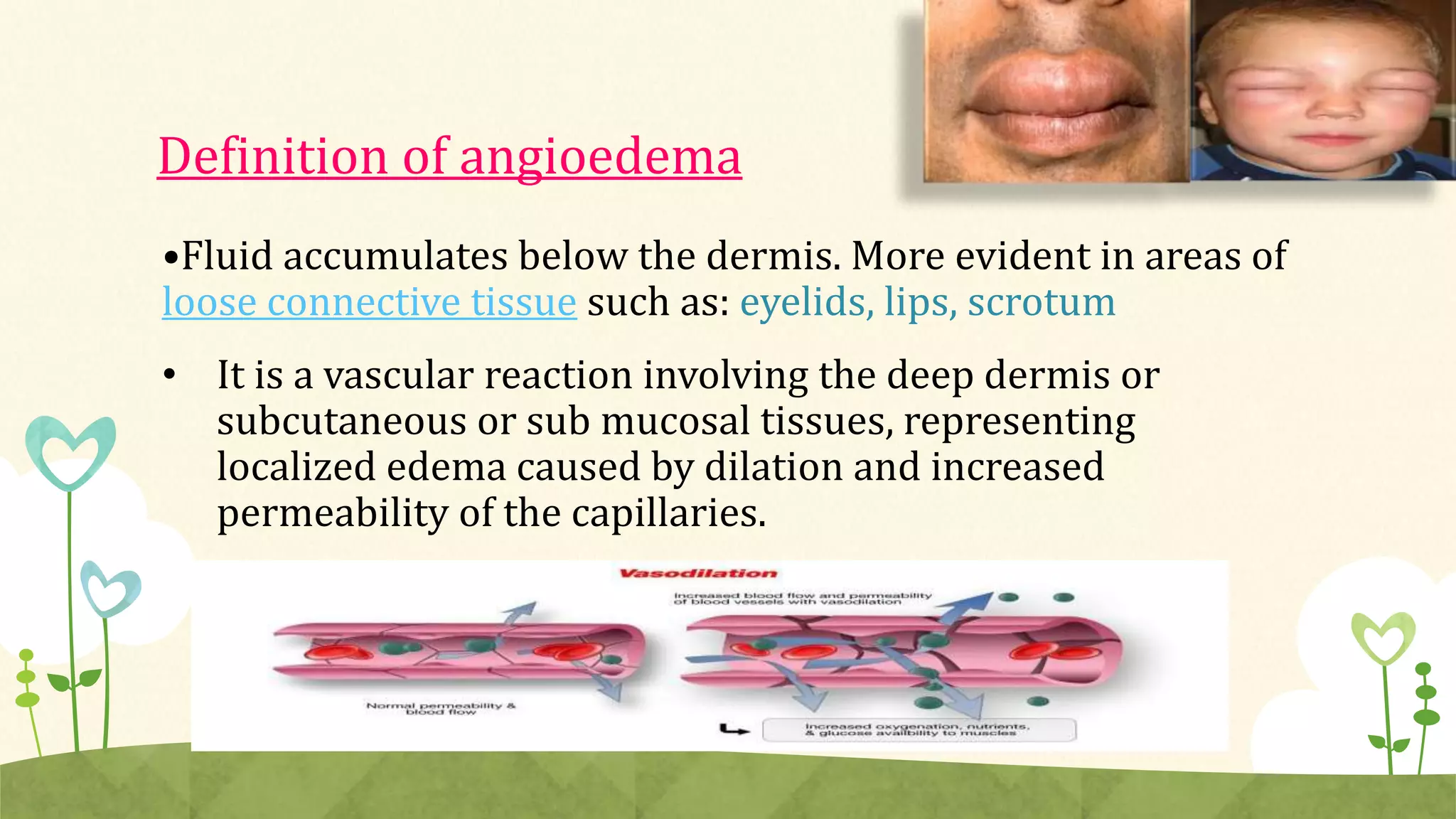 Angioedema | PPTX