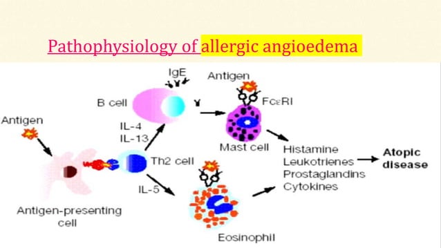 Angioedema | PPT
