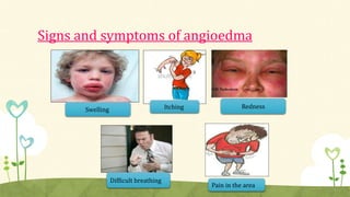 Angioedema | PPTX