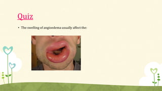 Angioedema | PPTX