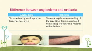 Angioedema | PPTX