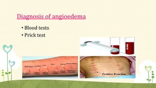 Angioedema | PPTX