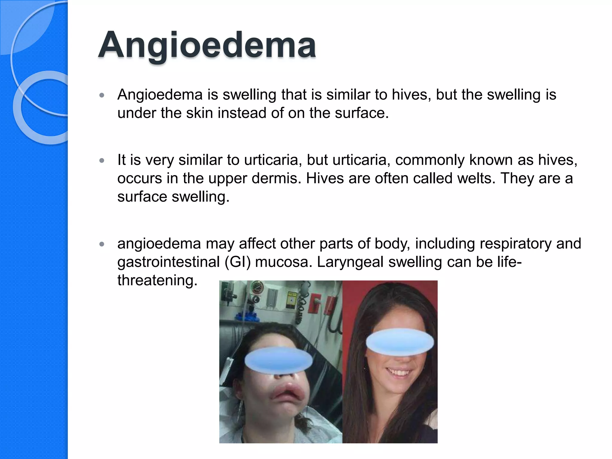 Angioedema | PPTX