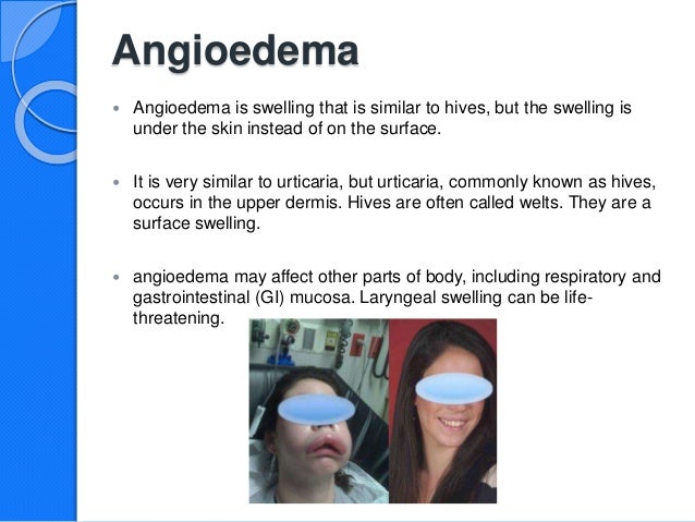 Angioedema