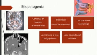Angiofibroma nasofaringeo juvenil | PPTX