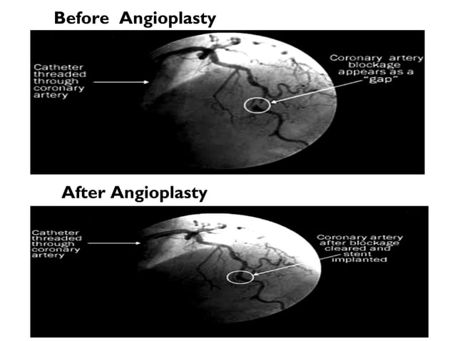 Angiogram | PPT