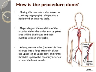 Angiography Procedure