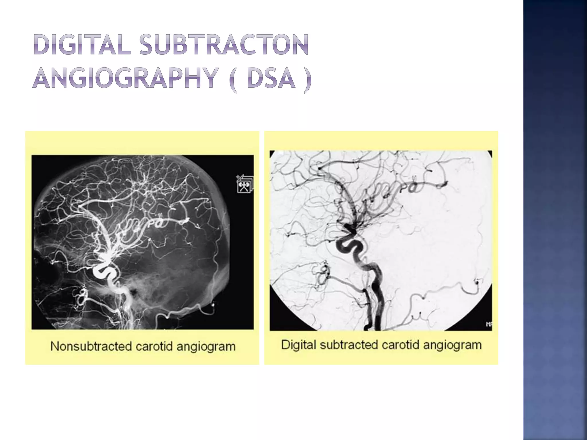 Angiography | PPTX
