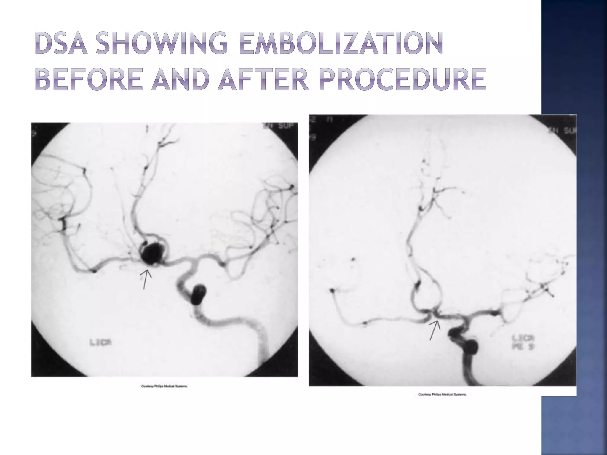 Angiography | PPTX
