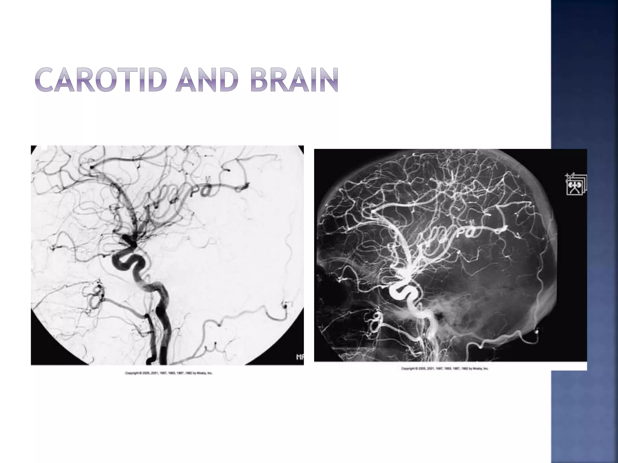 Angiography | PPTX