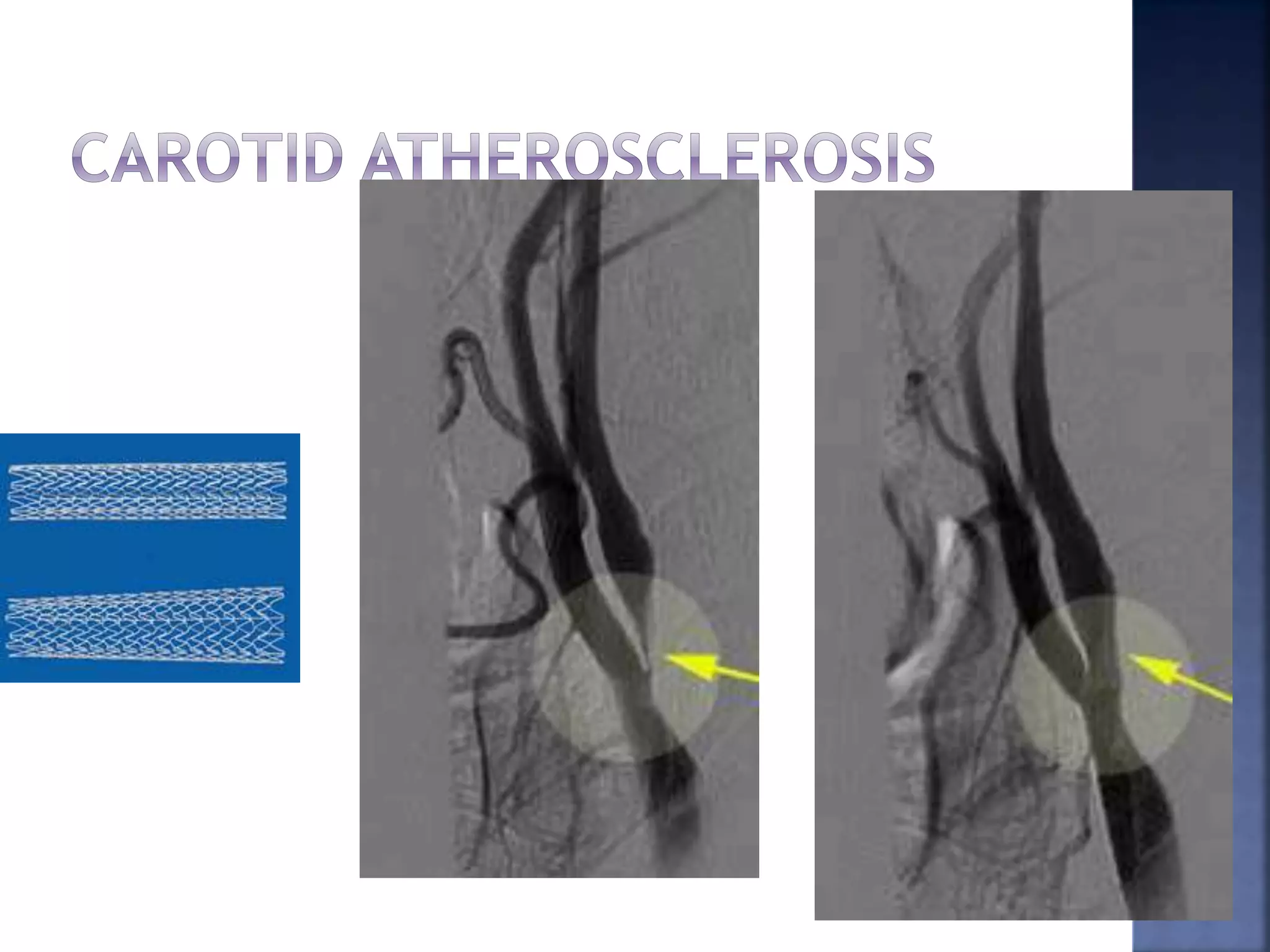 Angiography | PPTX