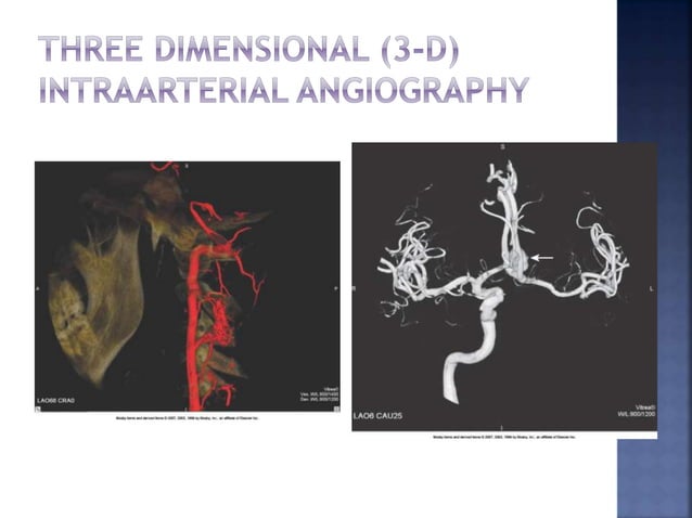 Angiography | PPTX