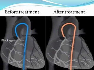 Angiography | PPTX