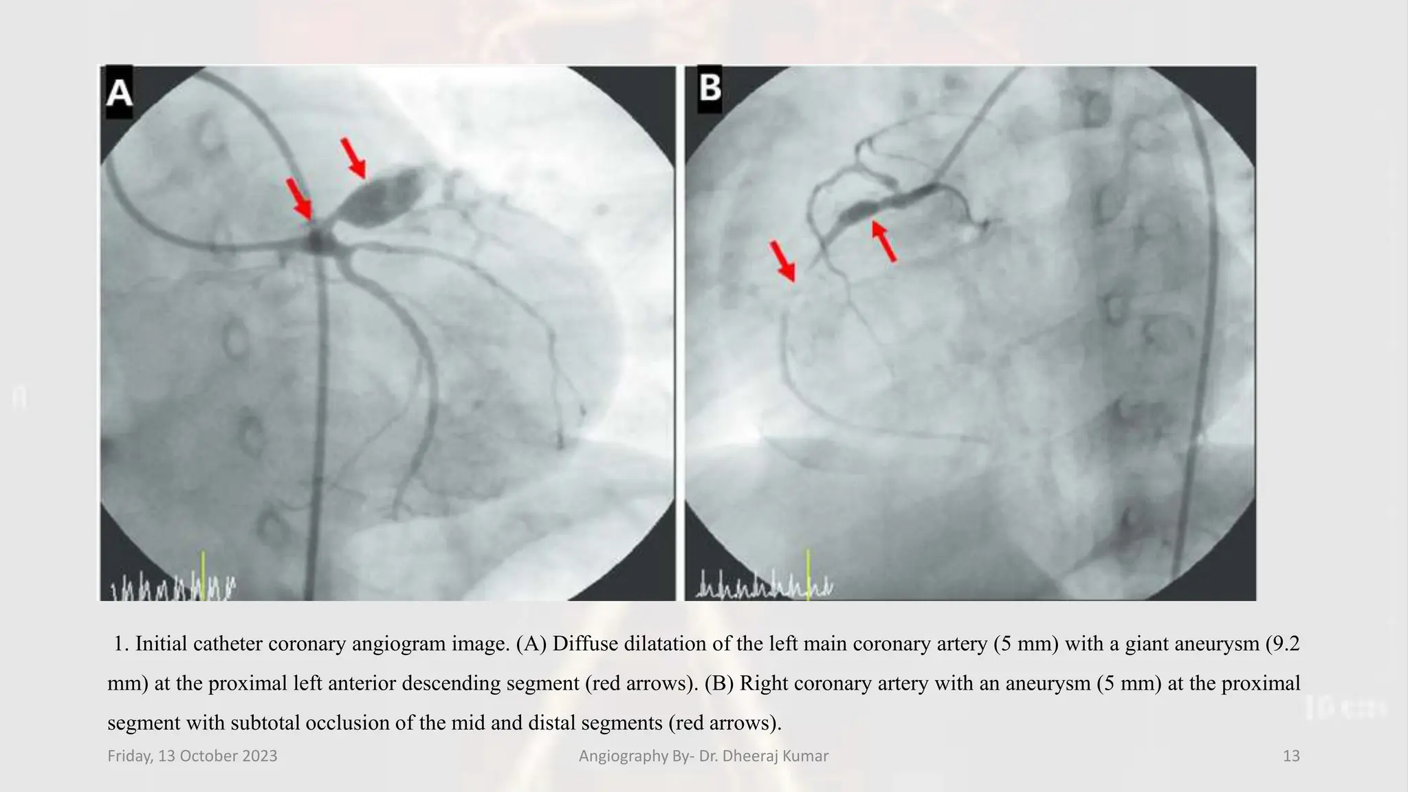 Angiography.pptx