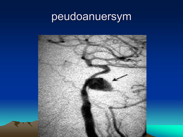 ANGIOGRAPHY in cardiothoracics surgery . | PPT