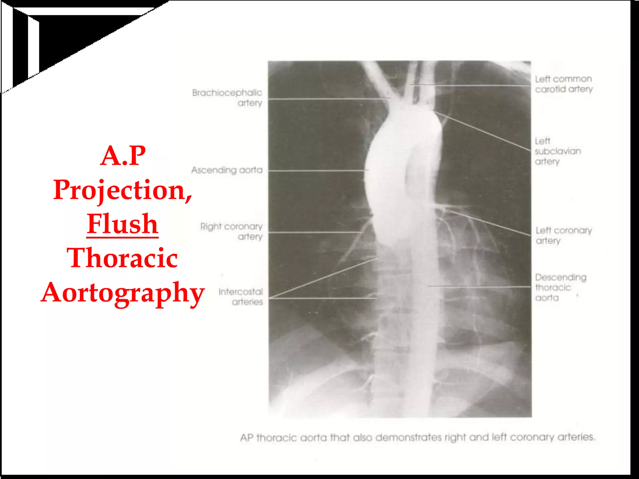 Angiography {arteriography} | PPSX