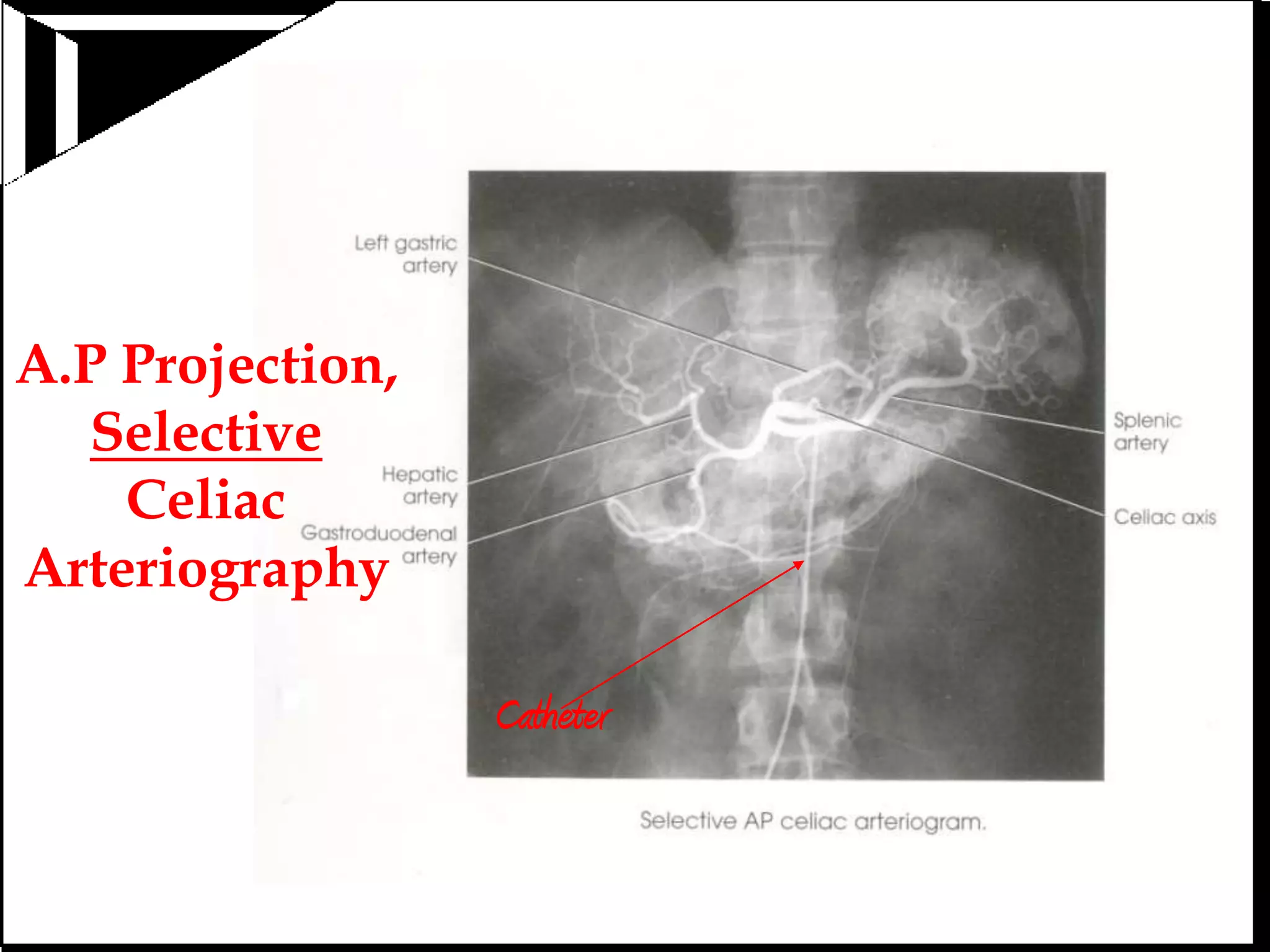 Angiography {arteriography} | PPSX
