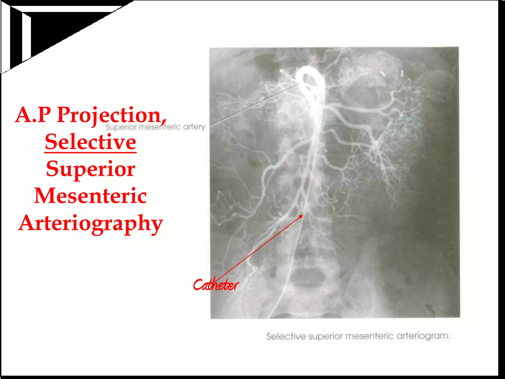 Angiography {arteriography} | PPSX