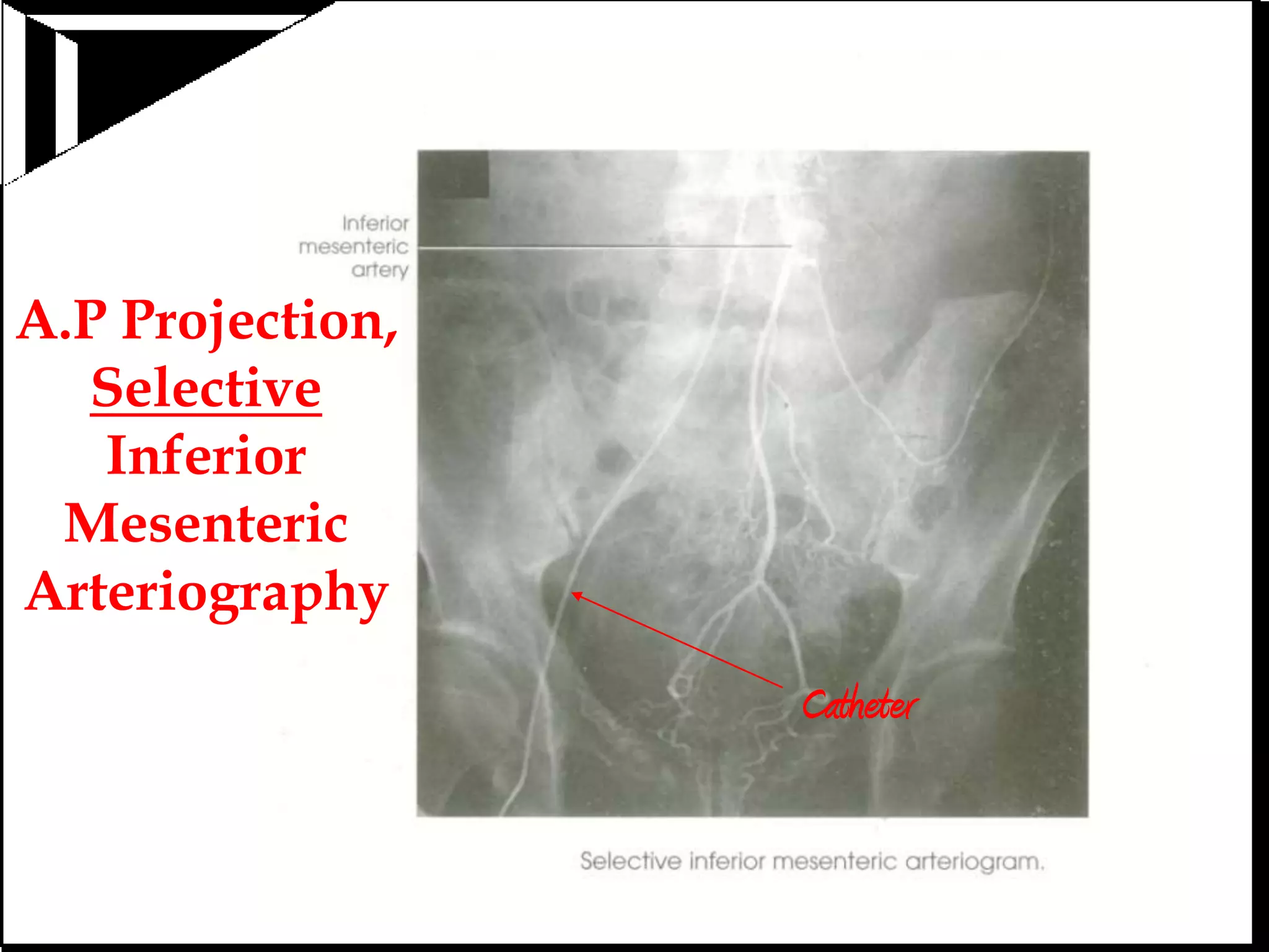 Angiography {arteriography} | PPSX