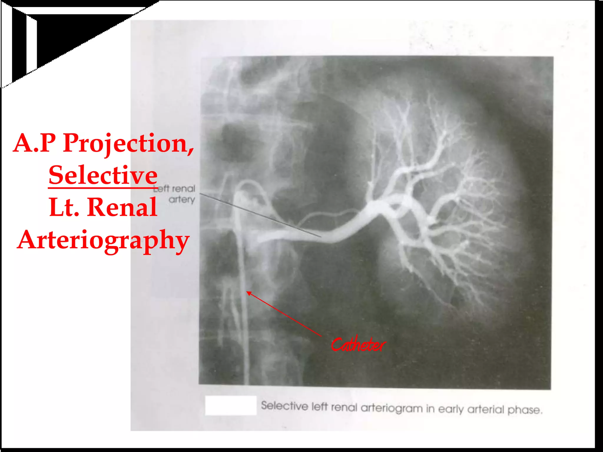 Angiography {arteriography} | PPSX