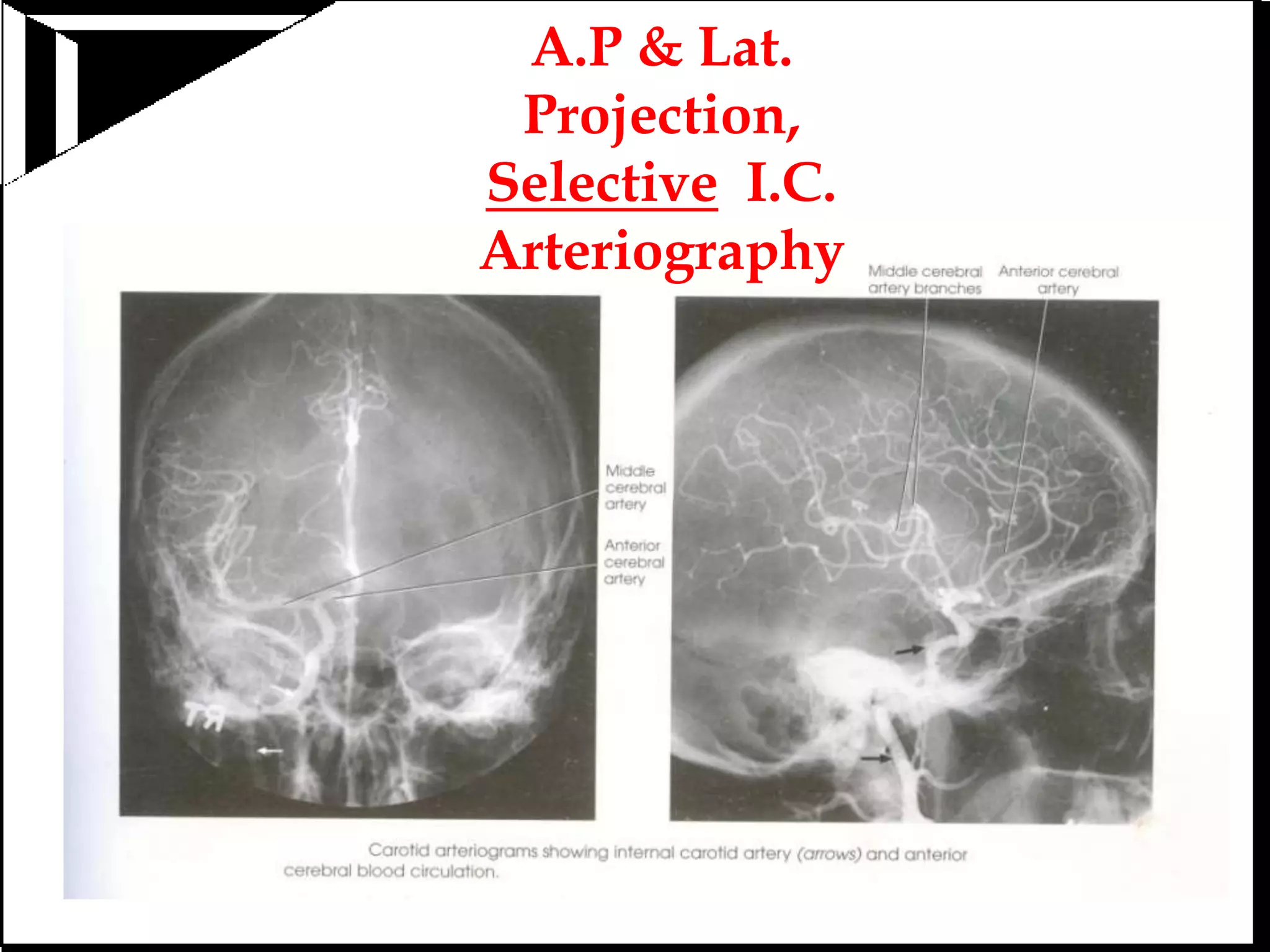Angiography {arteriography} | PPSX