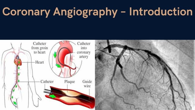 Angiography in India, Cost of Angiography in India.pdf