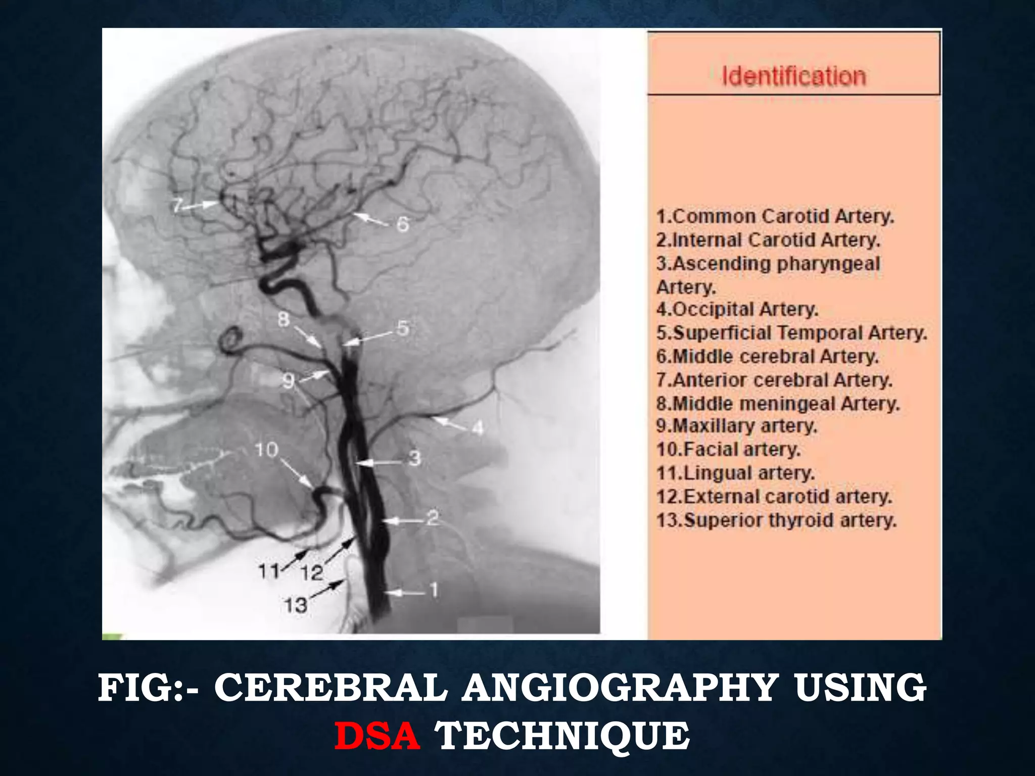 Angiography of Head and Neck | PPTX