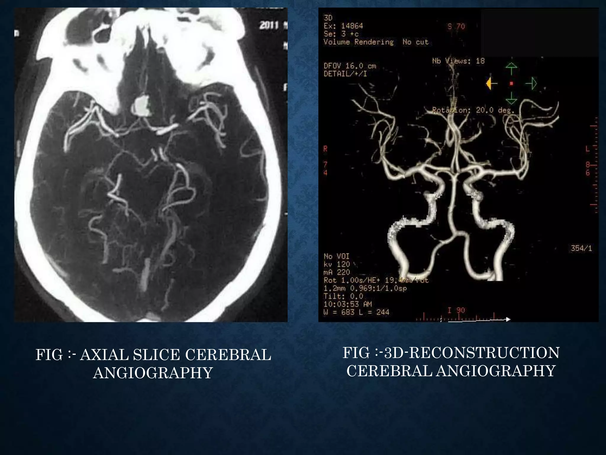 Angiography of Head and Neck | PPTX