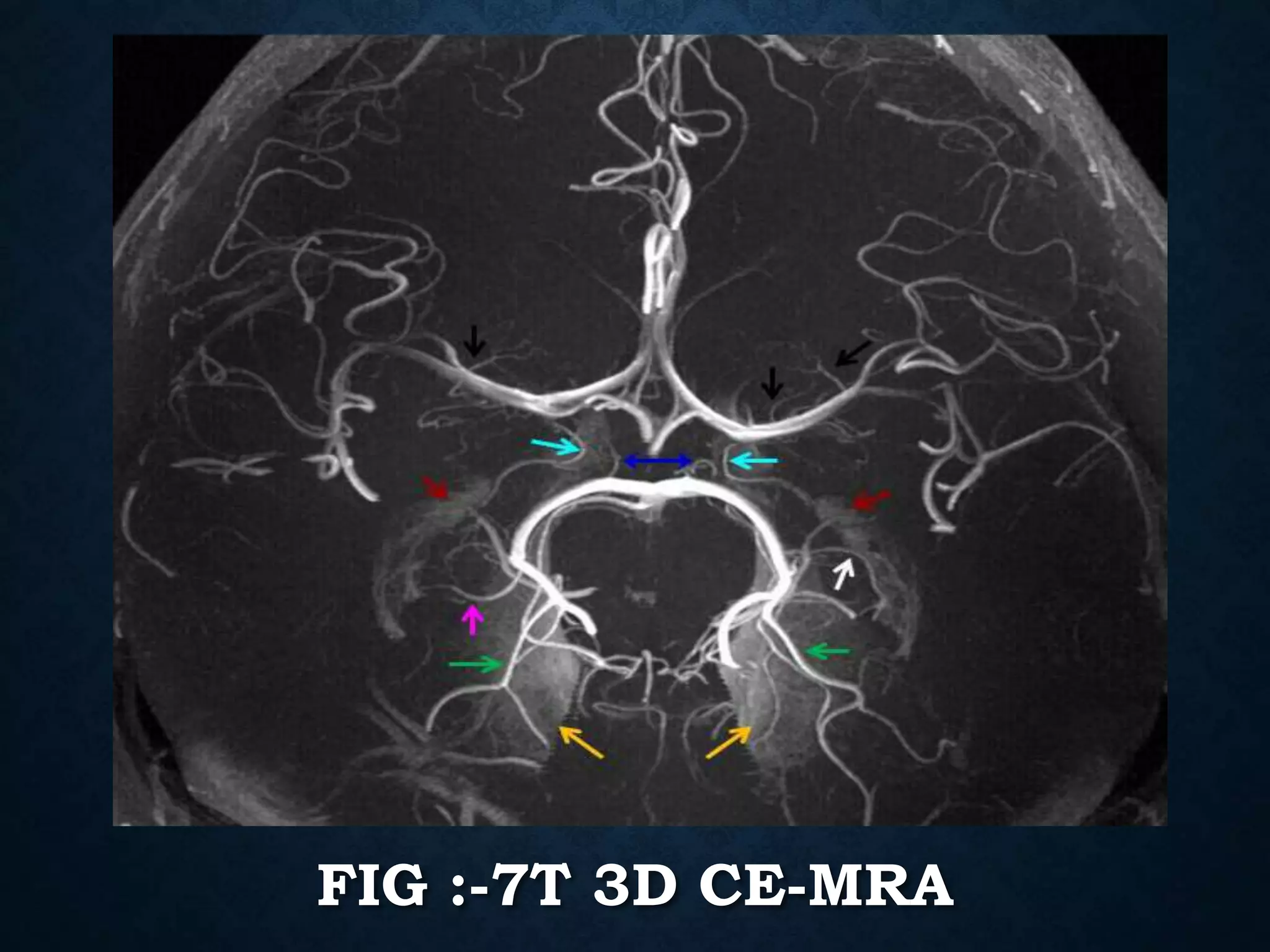 Angiography of Head and Neck | PPTX