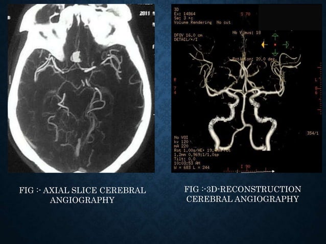 Angiography of Head and Neck | PPTX | Medical Tests | Medical Health