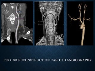 Angiography of Head and Neck | PPTX
