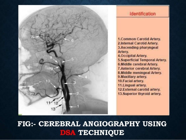 Angiography of Head and Neck