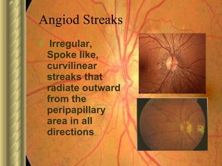 Angioid streaks | PPT