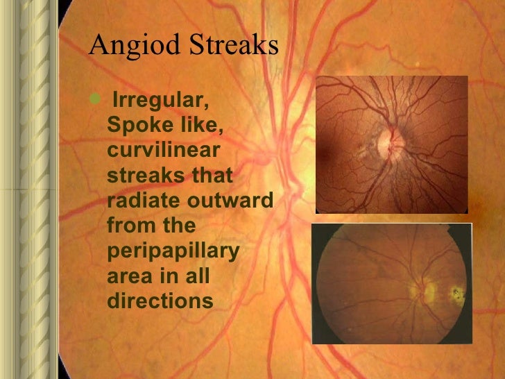 Angioid streaks