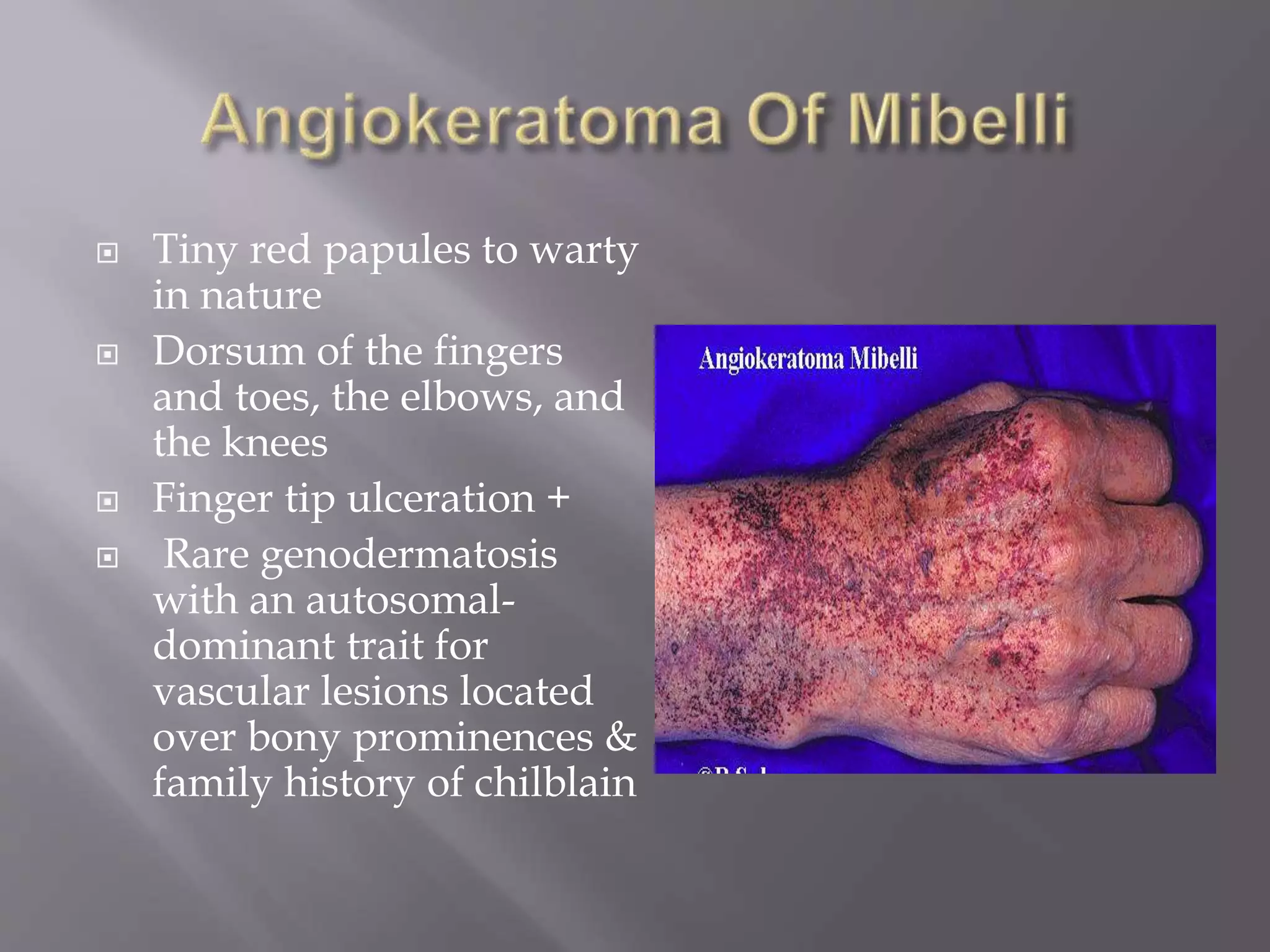 Angiokertoma & fabrys disease | PPTX