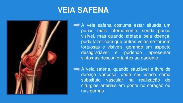 Veia Safena Magna Varicosa