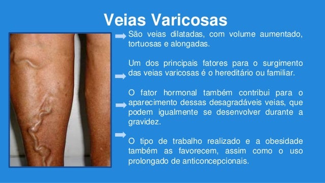 Angiologiarecife veias varicosas